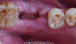 Consejos eficaces para aliviar el dolor tras la extracción de una muela