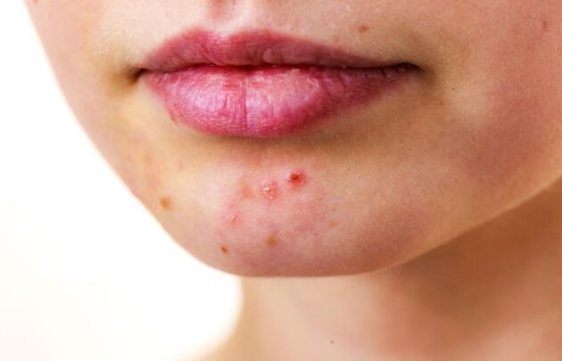 Acné infantil: mitos y realidades - Descubre la verdad sobre el acné en ...