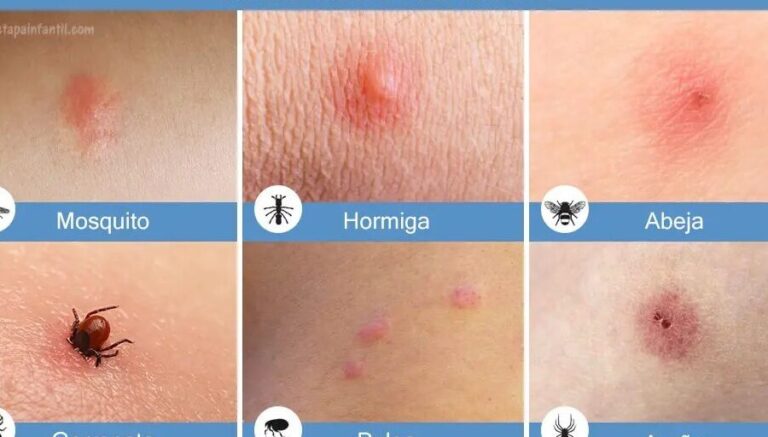 Picaduras comunes en la infancia: Guía para identificar y tratar