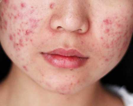 Efectos del acné en la piel de los niños: causas y tratamientos